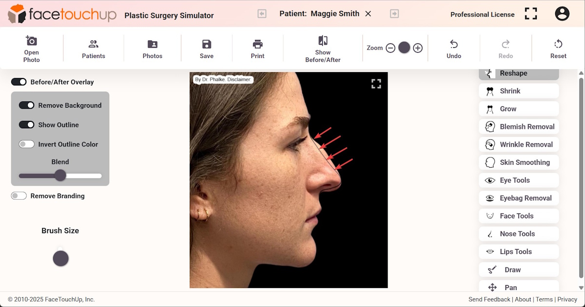 FaceTouchUp - #1 Plastic Surgery Simulator Morphing Software